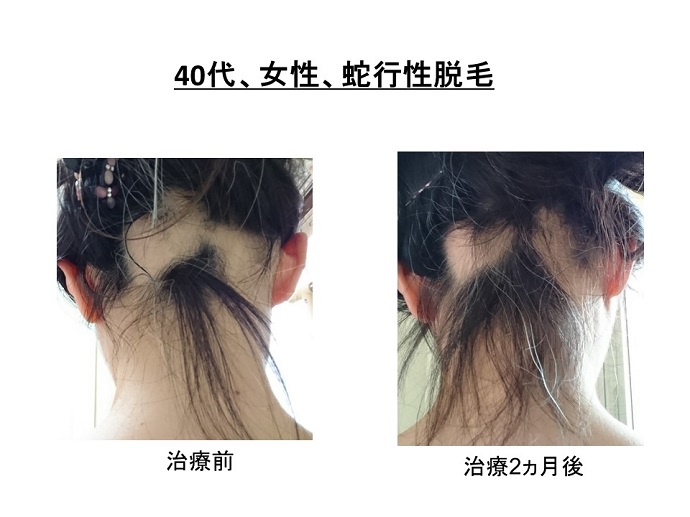 蛇行性脱毛の患者様、治療2ヵ月で、明らかな改善が！ 患者様からの声・メディア掲載・クリニックからのお知らせ 名古屋kクリニック